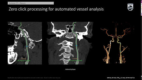 Philips Incisive CT | Mediscala